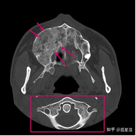 【罕见病】埃及狮身人面像的原型？骨性狮面症（Leontiasis ossea） - 知乎