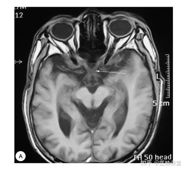 【收藏】十二对脑神经影像解剖图谱 - 知乎