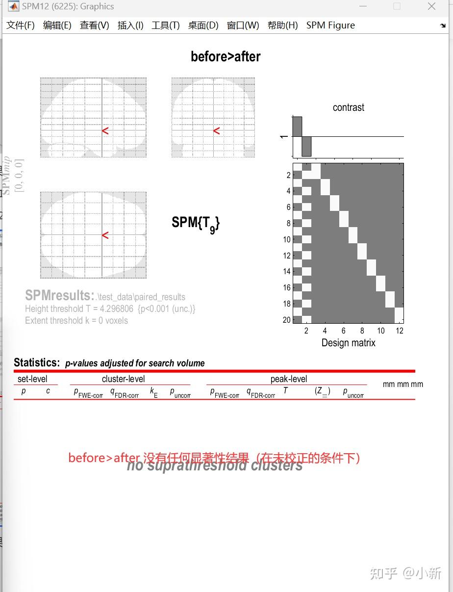 10-SPM-fmri任务态 二阶分析： 配对样本t检验 - 知乎