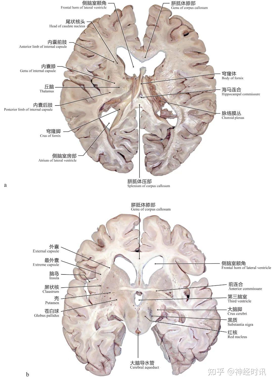 脑干的内部解剖、表面解剖（内附详细标注解剖图） - 知乎