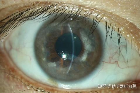 Cogan综合征诊治的研究进展 - 知乎