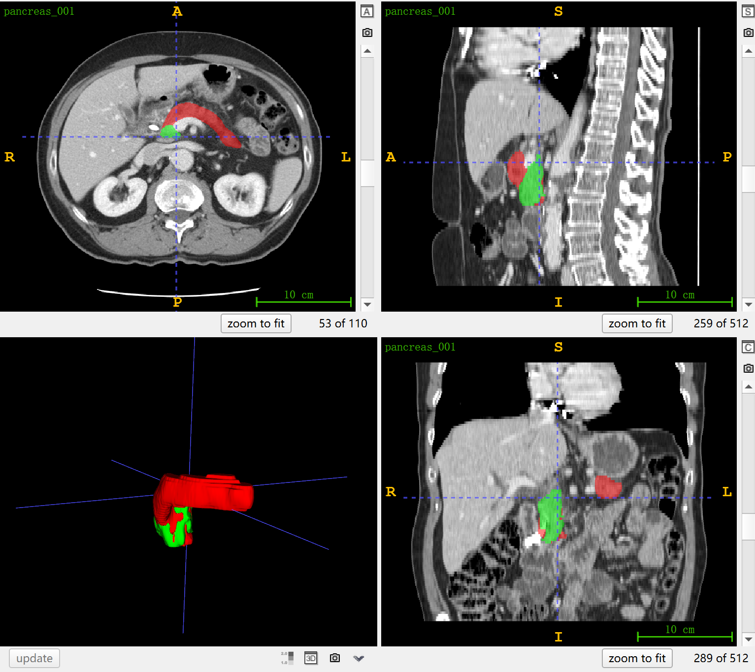 MSD Pancreas Tumour 数据集介绍 - 知乎