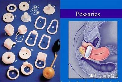 子宫托你知多少？ - 知乎
