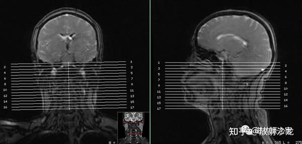 扫盲：腮腺MRI该如何扫描！ - 知乎