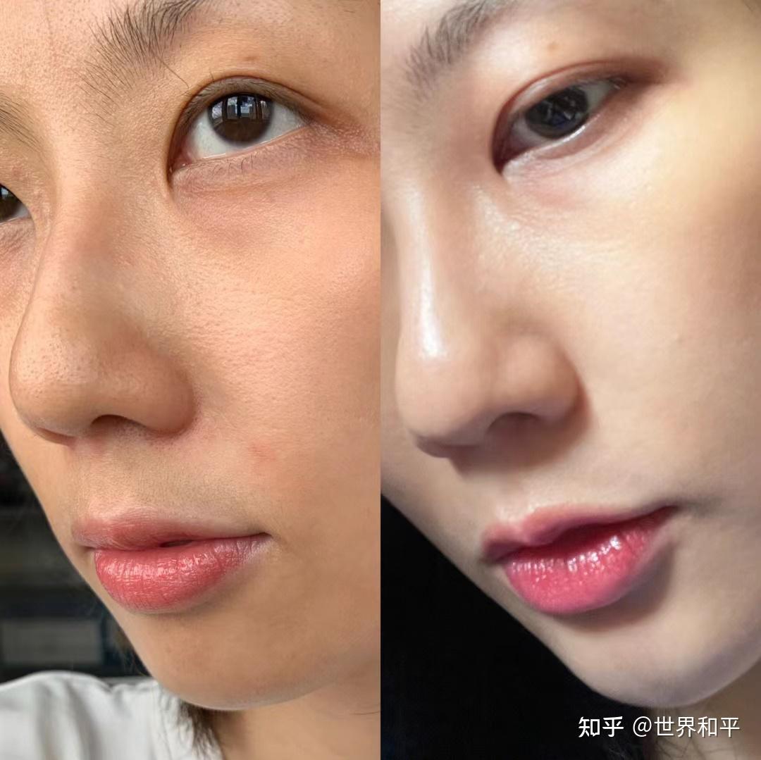 乳糖酸可以去鼻子上黑头和t区毛孔粗大吗?怎么使用?一天几次? 知乎