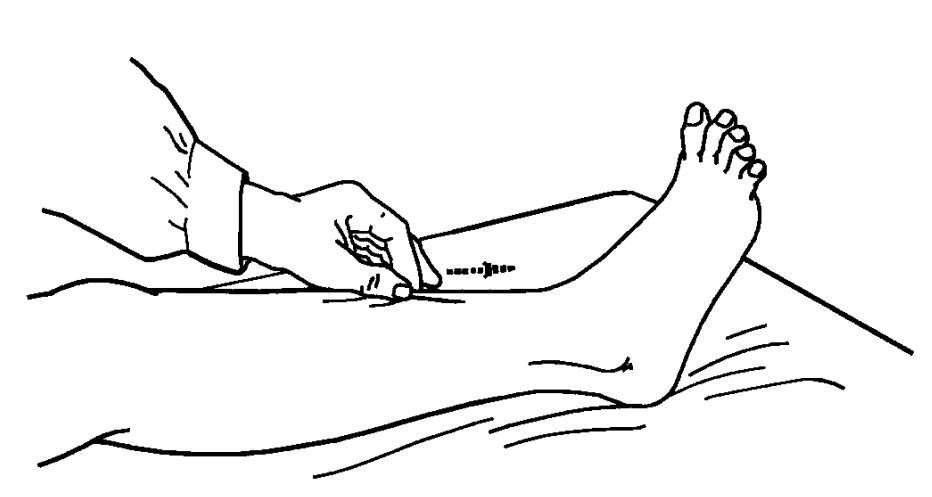 巴宾斯基（Babinski）征怎么查 - 知乎