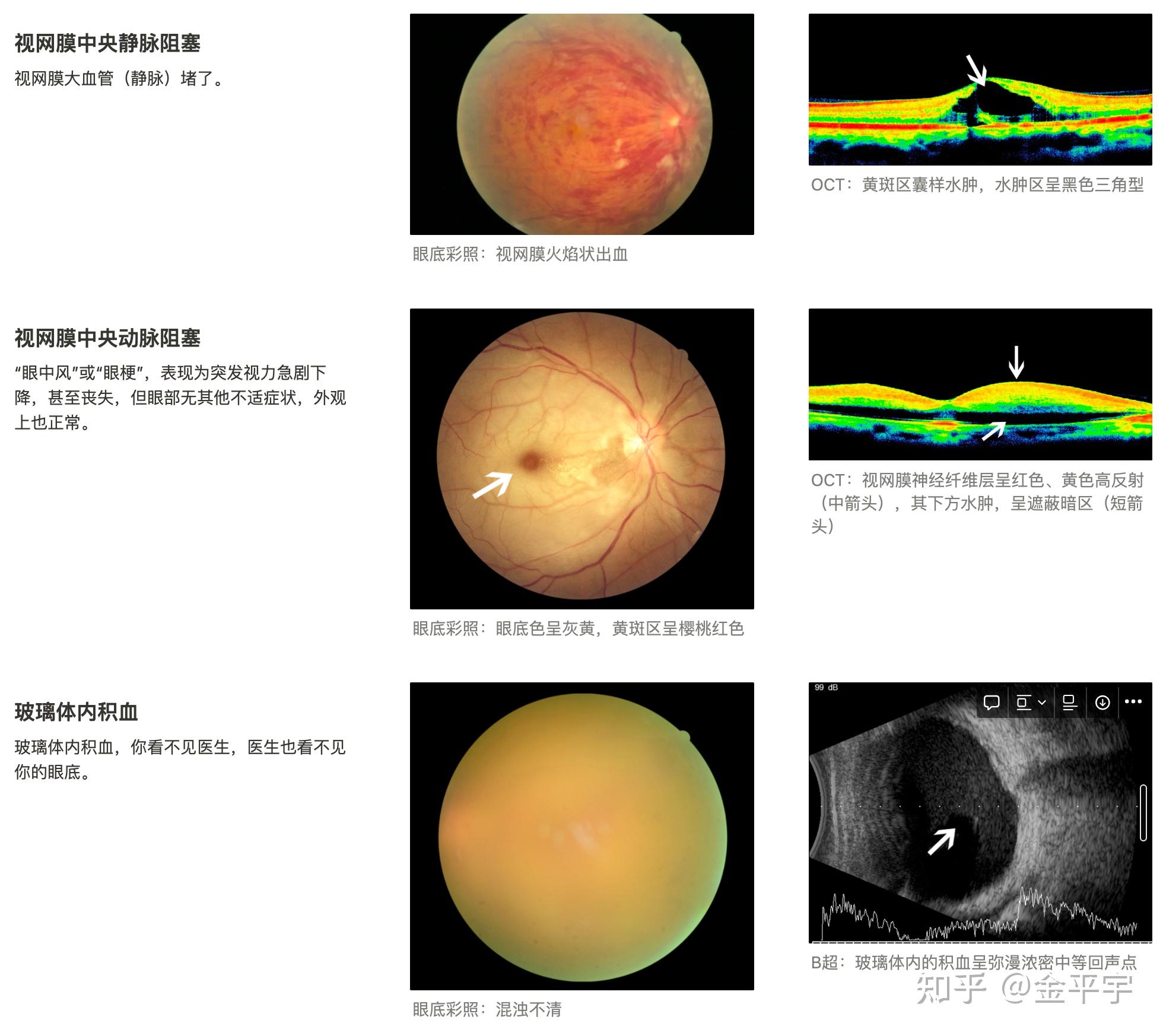 抗VEGF药物在眼底疾病治疗中的市场机遇与挑战 - 知乎