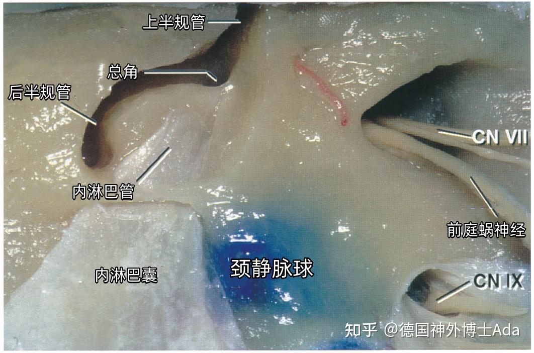 听神经瘤解剖---Rhoton解剖文献学习笔记系列 - 知乎