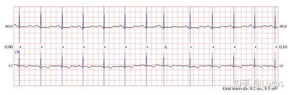 智能医疗（1）—— ECG心电图基础 - 知乎