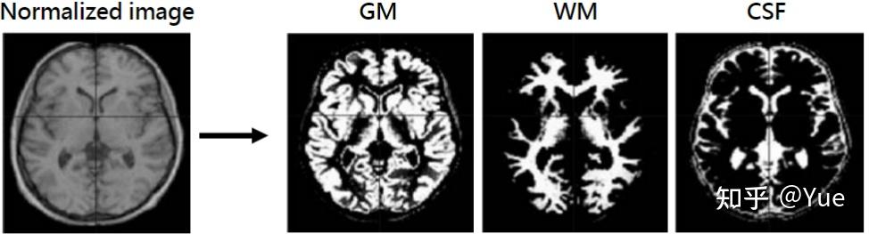 00_医学影像学习_MRI_VBM - 知乎