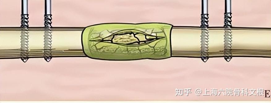 骨缺损不好修复？Masquelet技术来帮忙 - 知乎