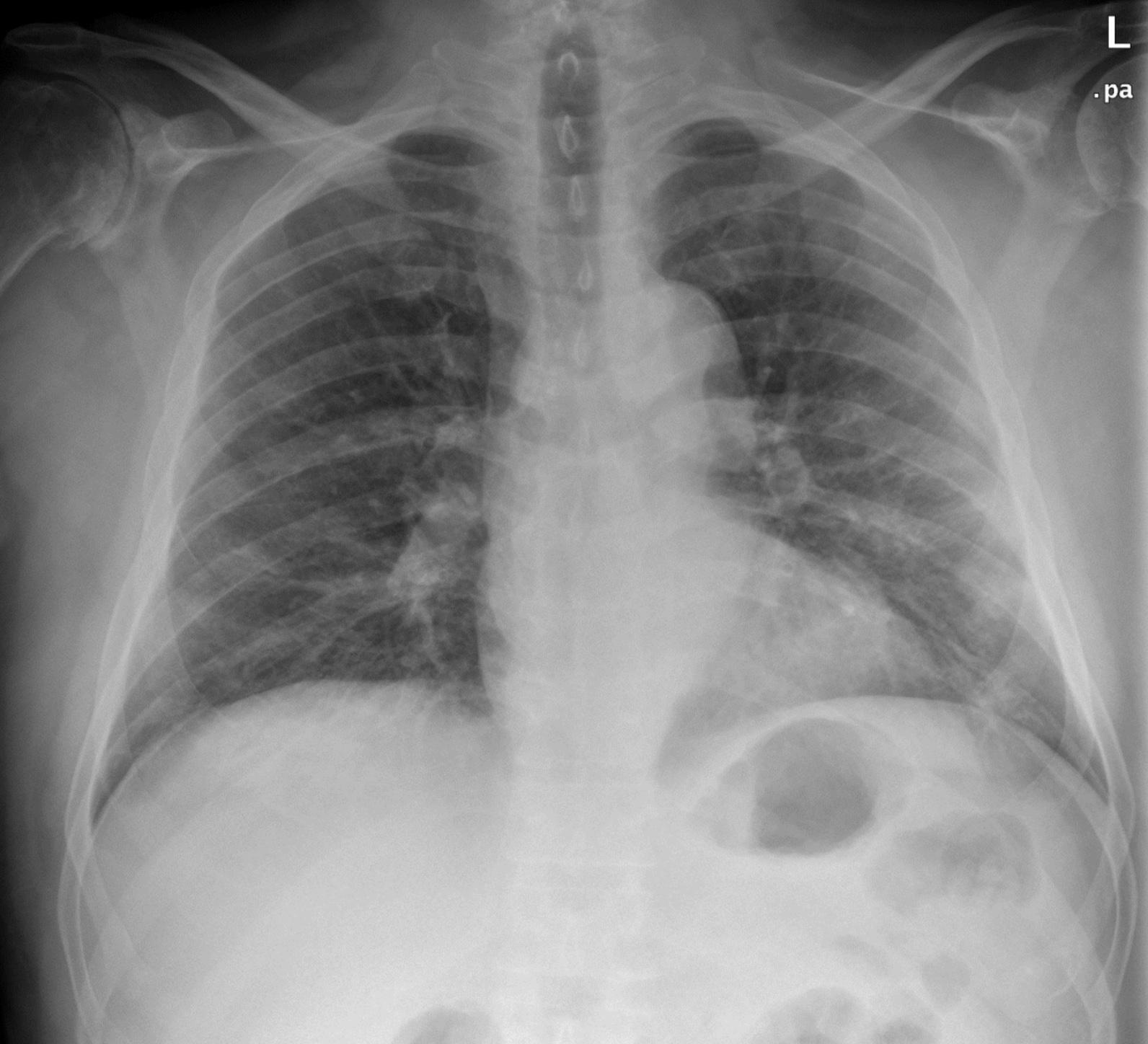 CoronaHack -Chest X-Ray 数据集介绍 - 知乎