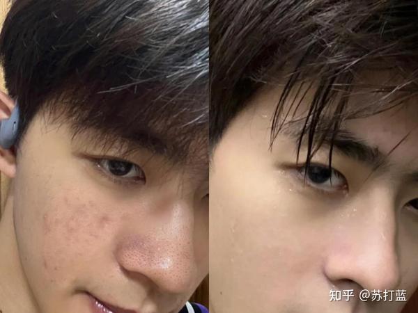 李佳琦推荐的洗面奶去黑头是真的猛!1个月 油腻屌丝”逆袭 清爽帅哥”! 知乎