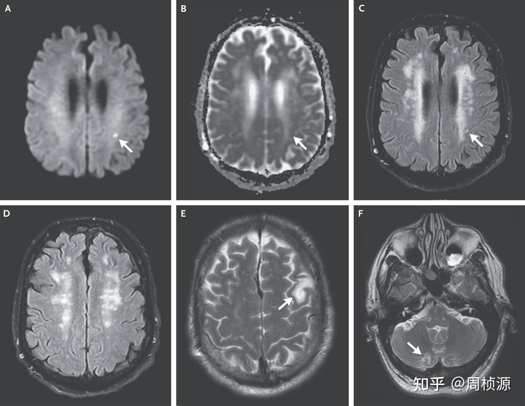 Nejm 2022 Case 1 - 知乎