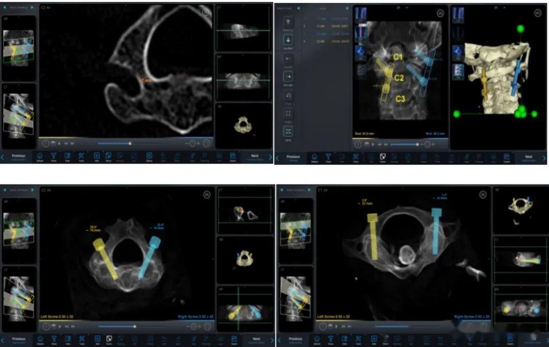 颈椎手术里程碑！美敦力Mazor X™️领跑未来 - 知乎