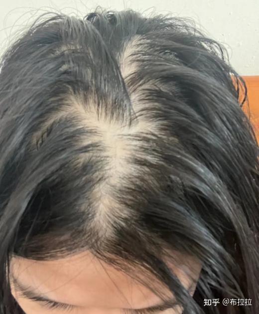 宝妈产后大把大把掉头发，发际线高、头发稀疏，有什么有效的防脱洗发水推荐吗？ 知乎
