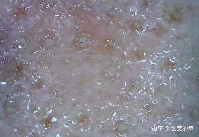 黑头太多反反复复的，有什么简单高效一步到位的去黑头方法？ 知乎