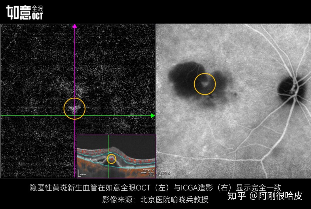 眼科OCT和OCTA到底是啥？什么时候需要做？ - 知乎