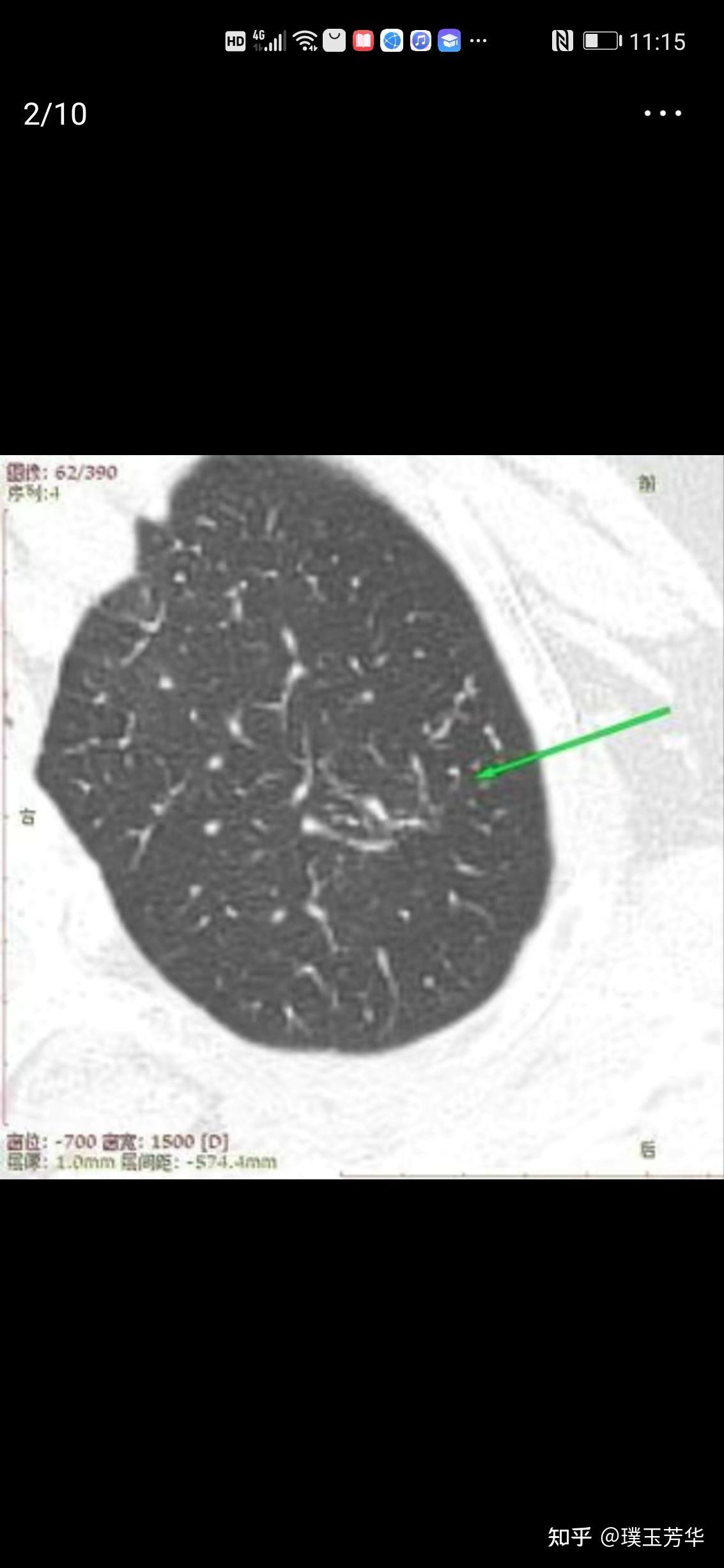 东北家庭再遇磨玻璃结节如何抉择？定心丸加治疗方案给出未来路 - 知乎