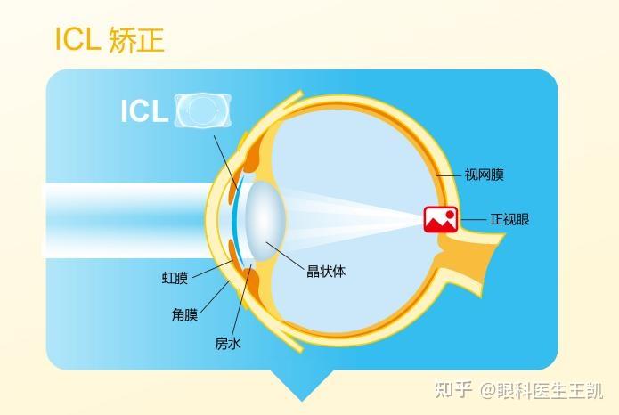 王凯医生工作室丨ICL晶体植入手术全攻略 - 知乎
