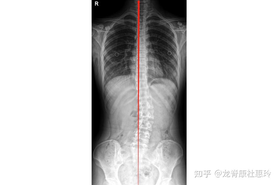 16岁脊柱侧弯女孩，反复腰痛四年，究竟是怎么回事？ - 知乎