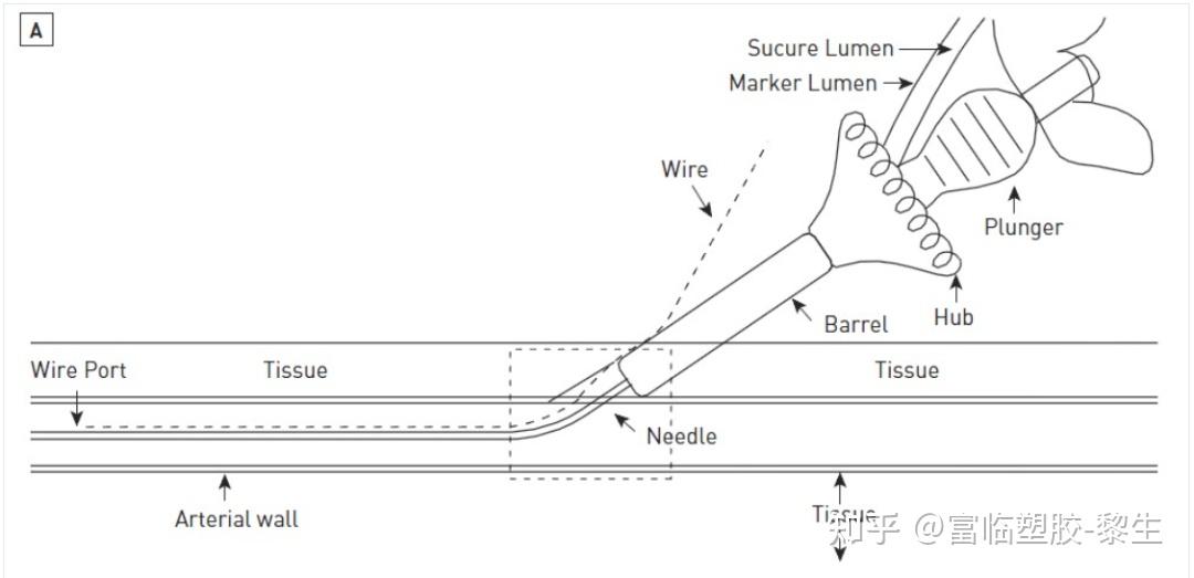 血管闭合：可以分为有源设备和无源设备 - 知乎