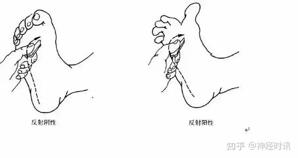 临床必备 | 神经系统体格检查，一文详解！ - 知乎