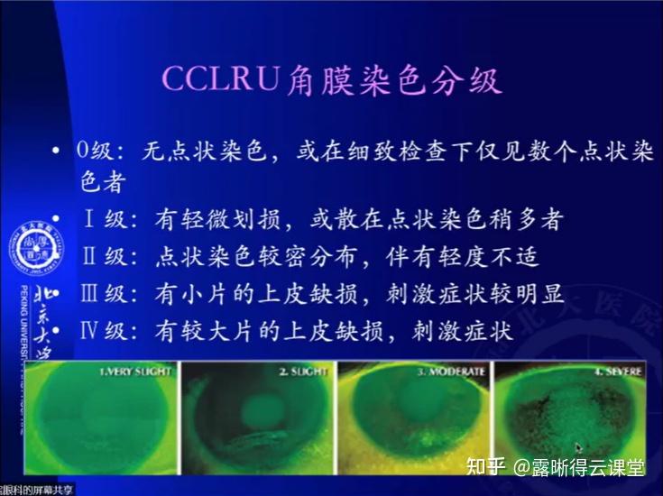 硬镜临床疑难案例实用诊疗指南——角膜篇 - 知乎