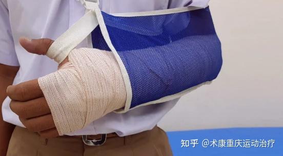手腕骨折康复1｜Colles骨折 - 知乎