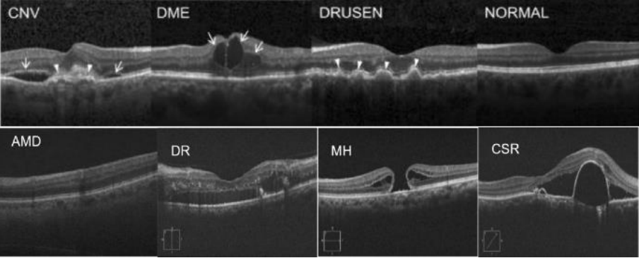 Retinal OCT-C8 眼科疾病诊断数据集介绍 - 知乎