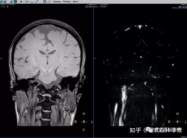 颅脑静脉MRV规范化扫描及临床应用 - 知乎