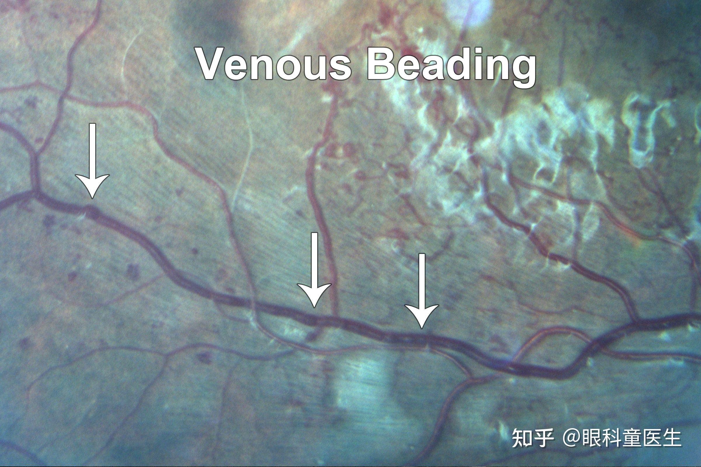 眼底彩照和眼底造影阅片 - 知乎
