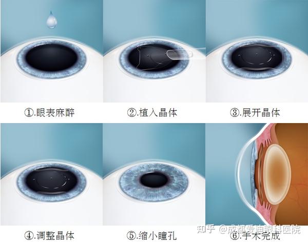 近视手术攻略-ICL晶体植入术篇 - 知乎