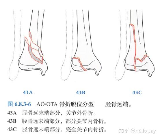 胫骨远端关节内骨折(Pilon骨折) - 知乎