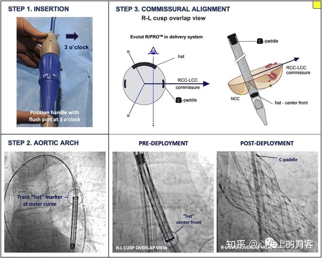 连合对齐（Commissural Alignment）：原理、定义、技术和结果（中） - 知乎