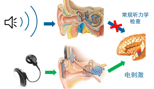 临床听力学技术专业沙龙 | 鲁兆毅：电刺激听觉诱发电位在人工耳蜗植入中的应用 - 知乎