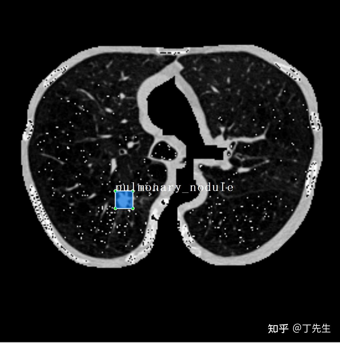 LUNA16肺结节数据集 - 知乎