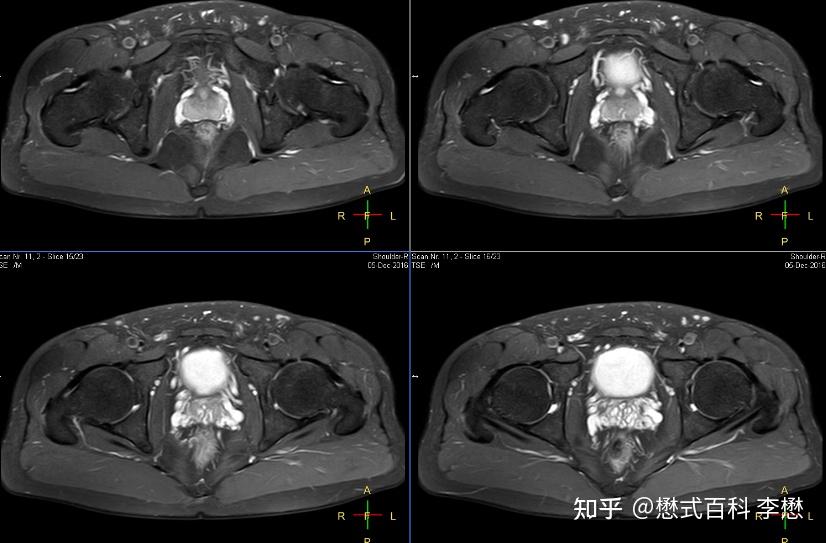 （双）髋关节磁共振扫描规范及临床应用 - 知乎