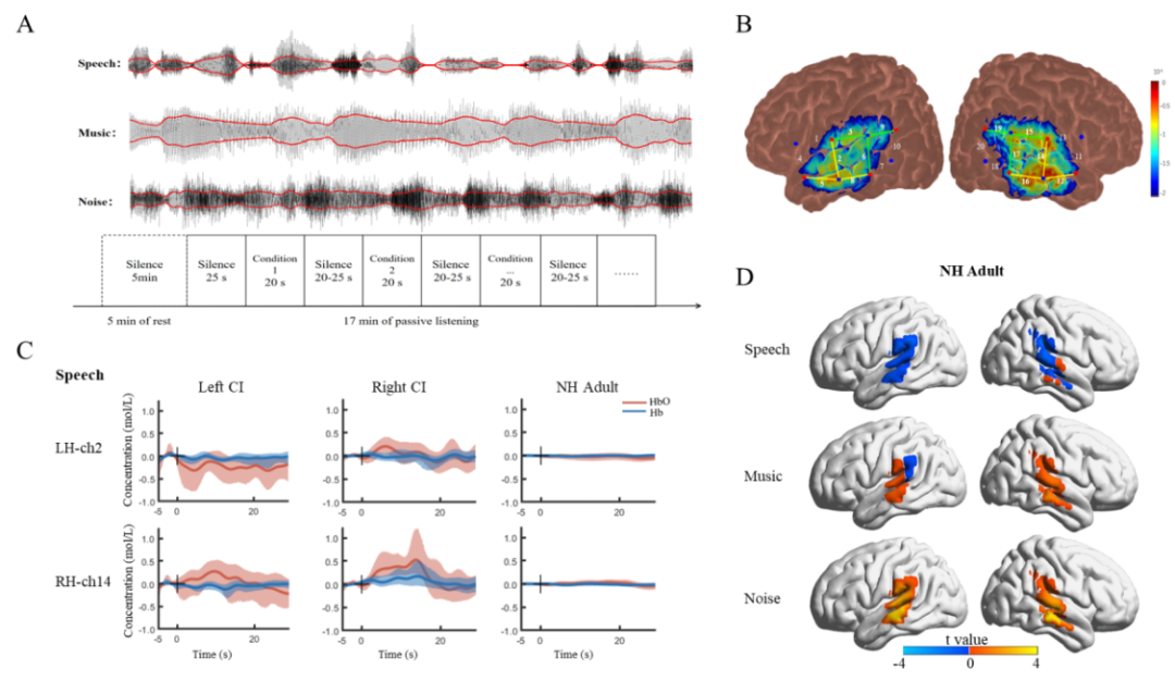 Cereb Cortex︱刘玉和/张语轩团队揭示左右侧人工耳蜗植入的发展差异 - 知乎