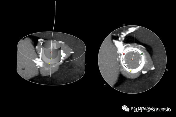3mensio Aortic - 知乎