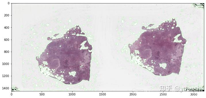 CLAM: A Deep-Learning-based Pipeline for Data Efficient and Weakly Supervised Whole-Slide-level ...