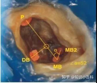 美亚口腔CBCT，让MB2无所遁形！ - 知乎