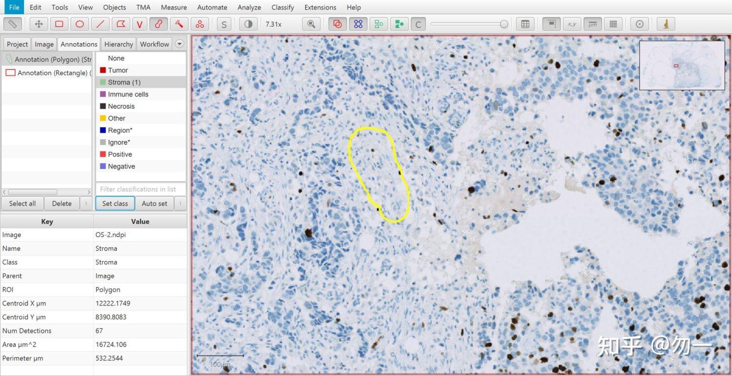 [数字病理]使用QuPath检测IHC阳性肿瘤细胞百分比 - 知乎