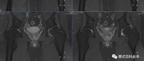 SPAIR序列的TR及TI设置 - 知乎
