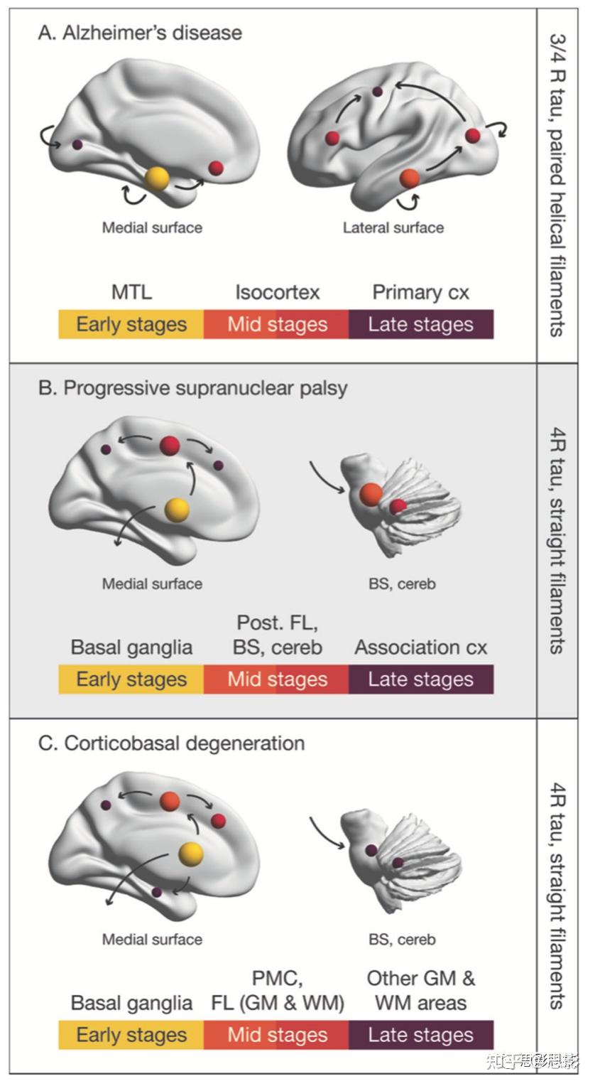 Tau PET成像在神经退行性Tau病中的应用—仍然是一个挑战 - 知乎
