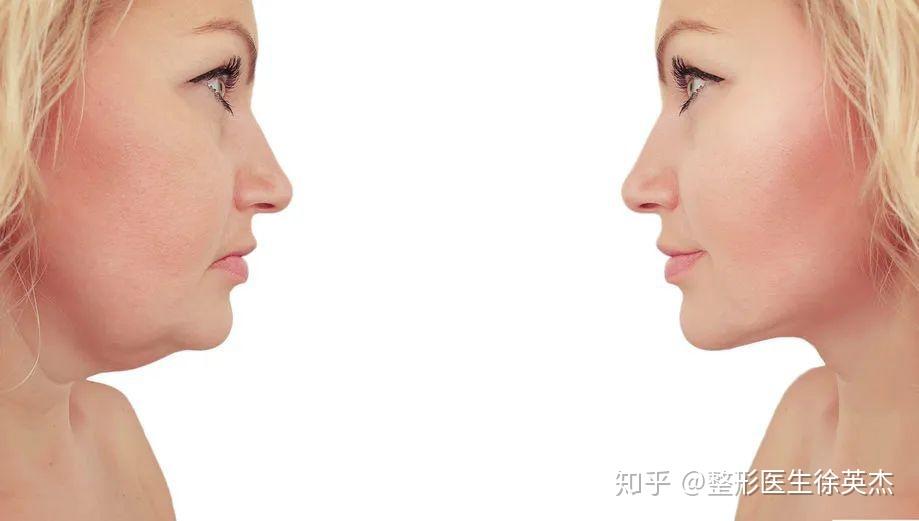 “大V线”和“小V线”有什么区别？线雕的根数和效果有直接关系吗？ - 知乎