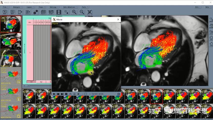 4D-Flow扫描数据采集：序列及参数 - 知乎