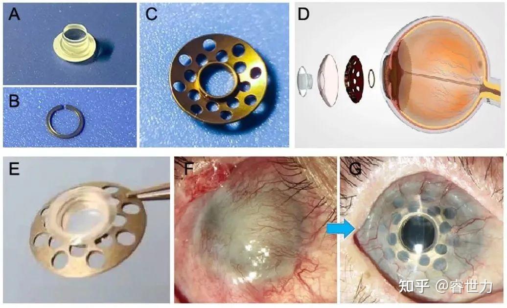 最新发布 | 2021年度“中国眼科学十大进展” - 知乎