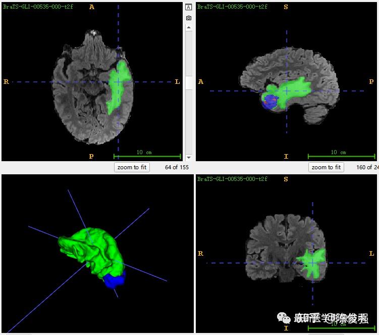 BraTS2023-GLI——BraTS2023成人胶质瘤分割挑战赛 - 知乎
