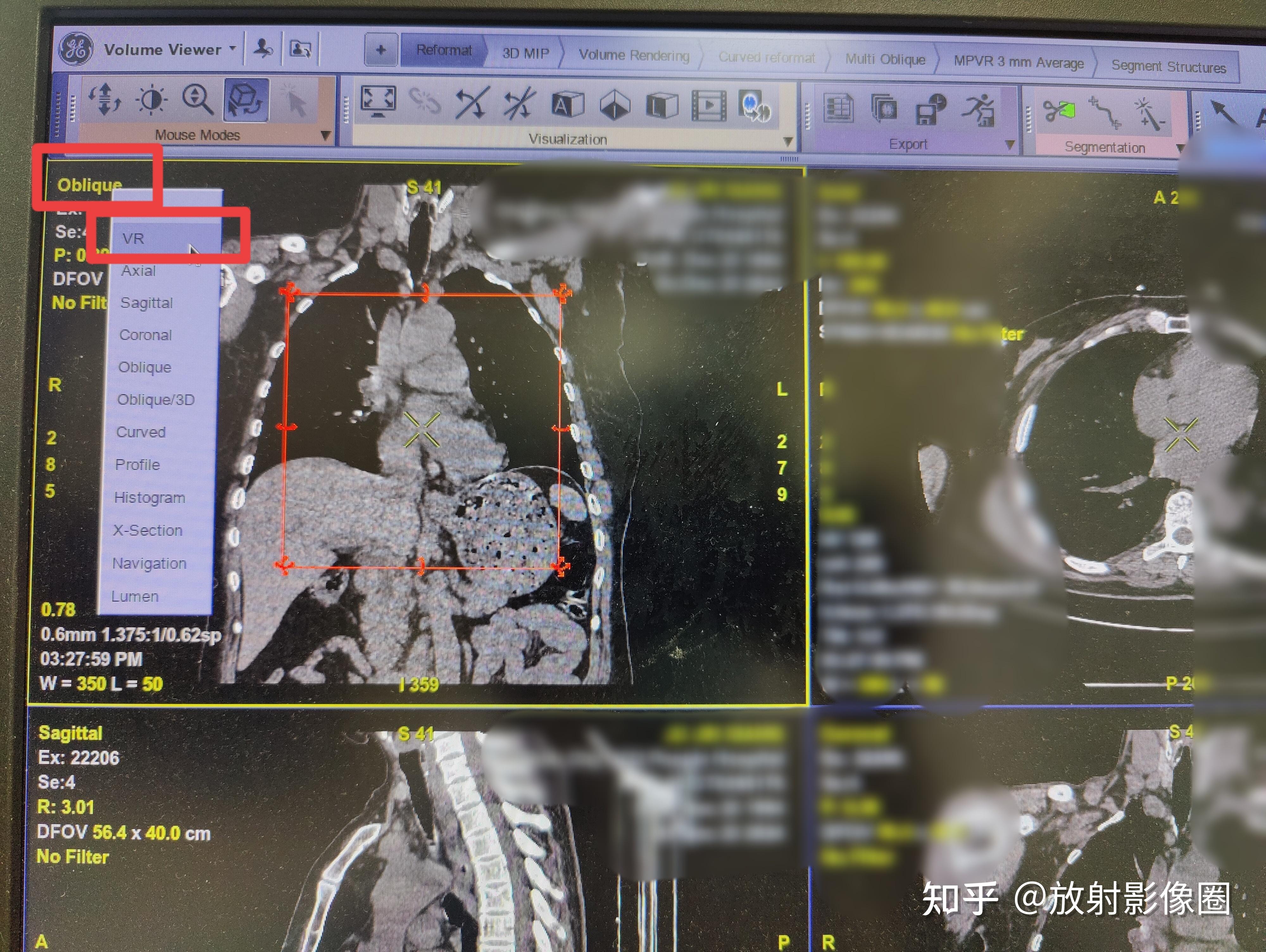 浅谈CT三维重建的操作方法 - 知乎